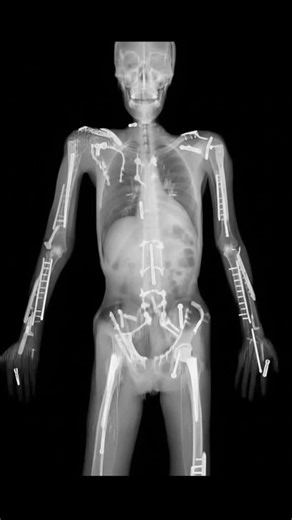 Nurse Chinel on Instagram: "The image shows an X-ray of Travis Pastrana's body, a professional stuntman, revealing metal plates, screws, and signs of numerous fractures. This showcases the remarkable physical toll that extreme sports athletes can endure and the incredible resilience required to push beyond limits. Doctors note that such injuries are common among professional stunt athletes, highlighting both the risk and remarkable resilience involved in this type of sport."
