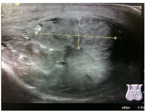 Salvaging Left Testicular Fracture After A Motorcycle Accident A Case