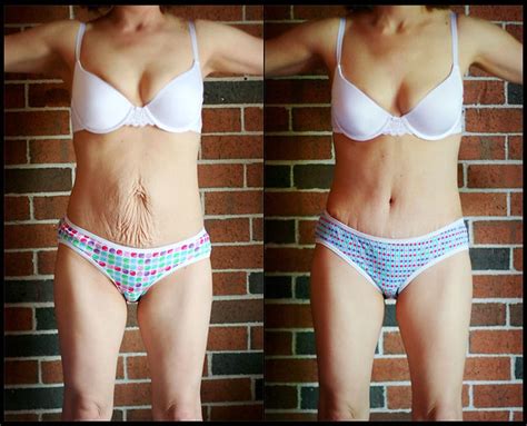 167 365 Tummy Tuck Day 22 Before And After 5 22 08 Day… Flickr