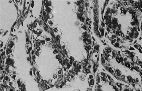 Figure 2 From Clear Cell Adenocarcinoma Of The Uterine Cervix A
