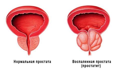 Calcification In The Prostate Gland The Prostate What Is It Causes