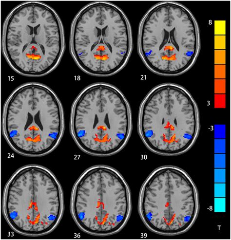 frontiers abnormal default mode network homogeneity in treatment