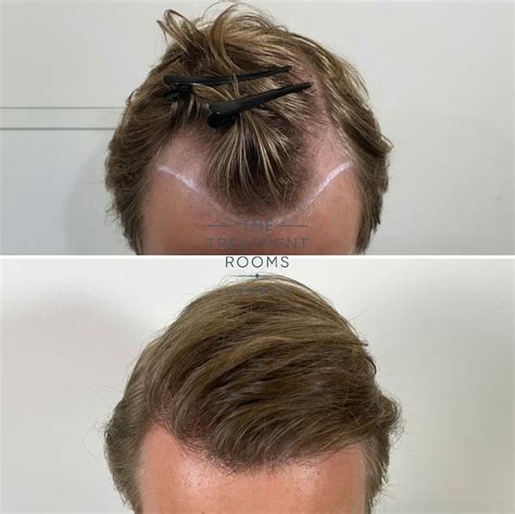 The Best Hair Loss Treatments For Men