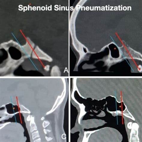 Sphenoid Sinus Pneumatization Types