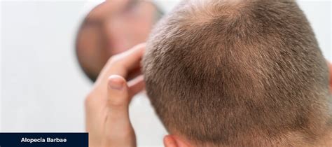 Alopecia Barbae Causes And Solutions Smile Hair Clinic