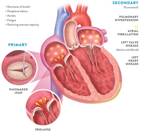 Treat Mitral Regurgitation And Aortic Stenosis