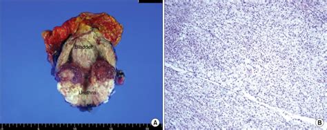 Gross Findings Were Of An Exophytic Friable Mass At The Urethra And The