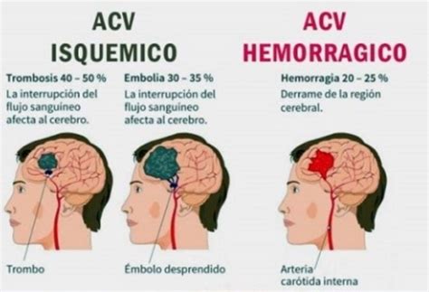 Acv Tiempo Perdido Es Cerebro Perdido Noticias Bariloche