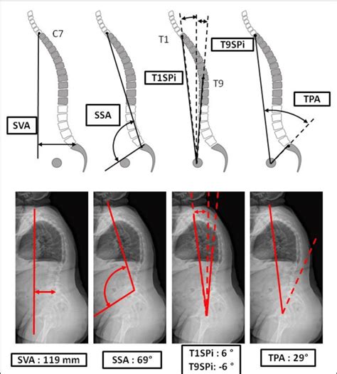 Sagittal Vertical Axis Sva Spino Sacral Angle Ssa T1 Sagittal