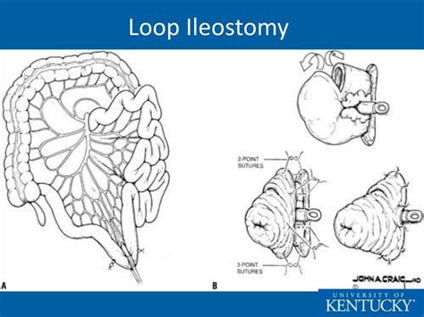Ppt The Difficult Stoma Powerpoint Presentation Free Download Id