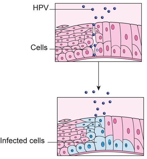 Hpv And Cervical Cancer Jos Cervical Cancer Trust