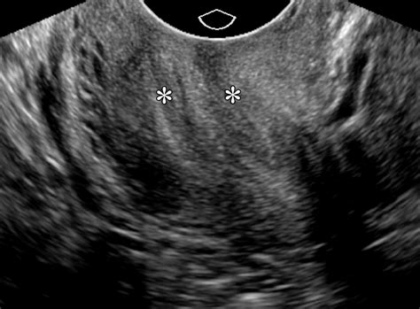 Us Of The Nongravid Cervix With Multimodality Imaging Correlation