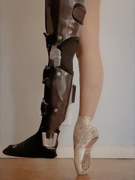 Después De Un Cáncer Volvió Al Ballet Gracias A Una “pierna Robótica” Y