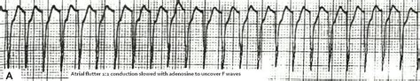 10 tips to diagnose atrial flutter on an ekg