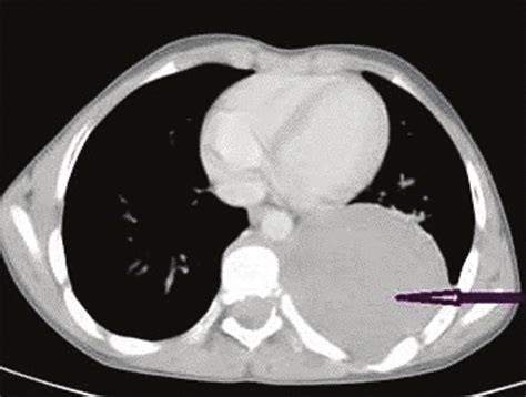 Axial Contrast Enhanced Computed Tomography Image Demonstrating A