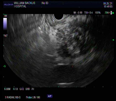 Hypoechoic Gland With Hyperechoic Foci Without Shadowing Download