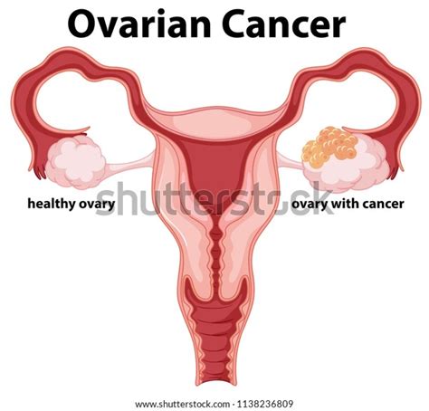 Woman Ovarian Cancer Concept Drawing Illustration 库存矢量图（免版税）1138236809