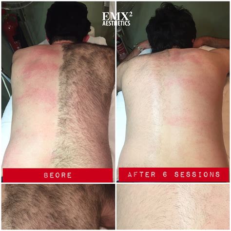 Laser Hair Removal After 6 Treatments Clearance