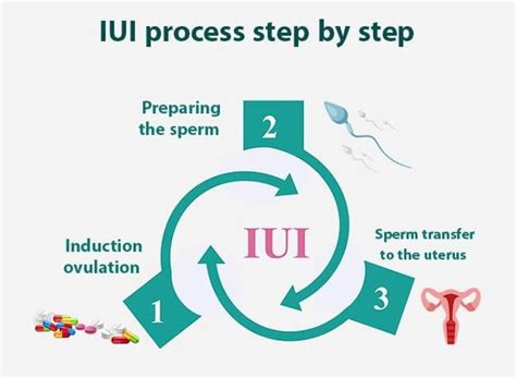 Intrauterine Insemination Iui Intrauterine Insemination Success