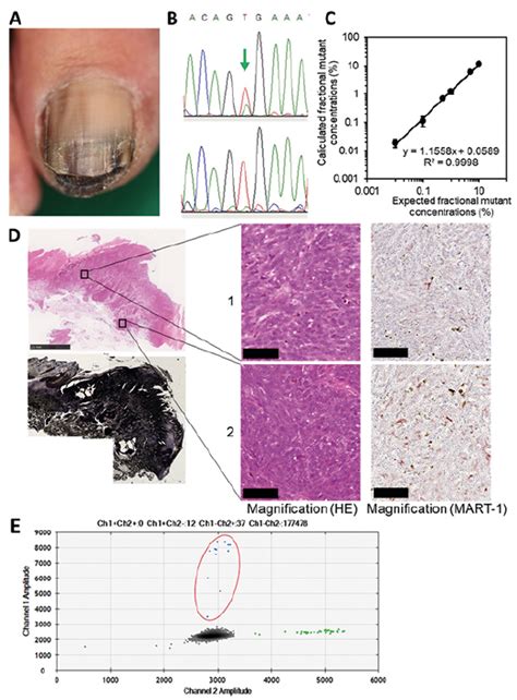 Braf Mutation Heterogeneity In Melanoma Lesions Html Acta Dermato