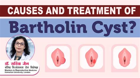 Causes And Treatment Of Bartholin Cyst Dr Sarita Jain Arihant Ivf