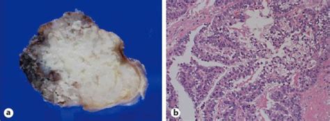 Pathological Examination Of The Intracranial Tumor A Macroscopic