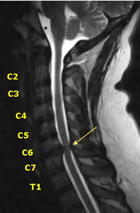 Cervical Spine Mri Comparison