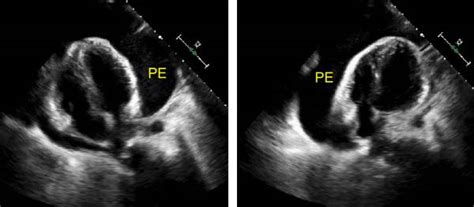 Electrical Alternans In Pericardial Effusion All About Cardiovascular