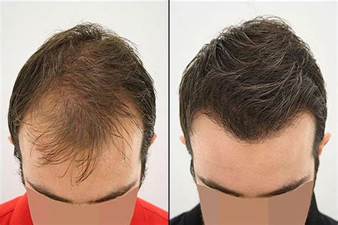 Hair Transplant Aftercare ♥ Amitis