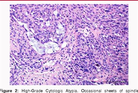 Figure 2 From Rare Breast Myoepithelial Carcinoma With A Distinctive