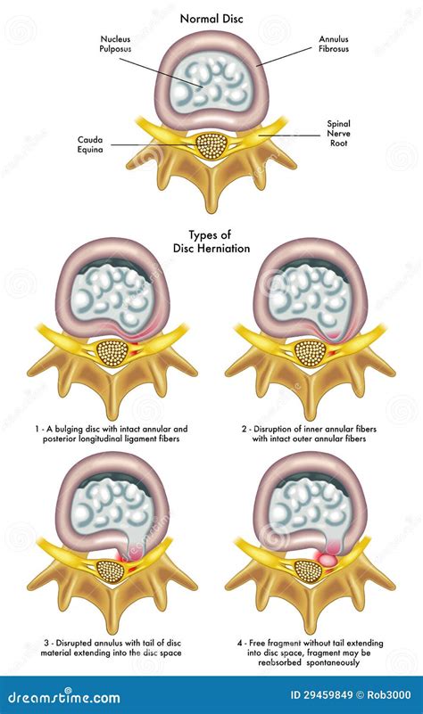 Herniated Disc Stock Vector Illustration Of Rehabilitation 29459849