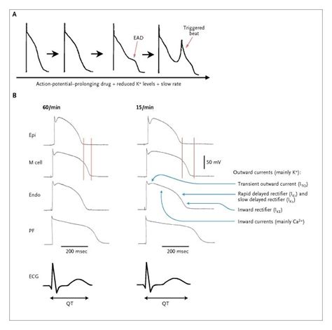 Drug Induced Prolongation Of The Qt Interval Nejm