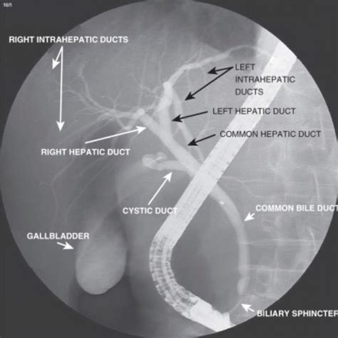 cholangiogram biliary anatomy on ercp cholangiogram grepmed