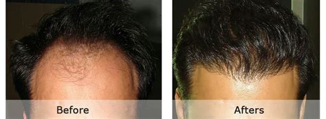 Hair Transplant In Pakistan Lahore Low Price Best Fue Surgery