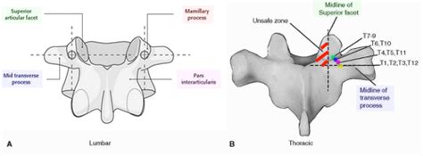 pedicle screw insertion simplified epomedicine