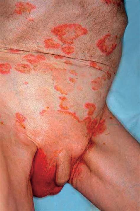 Figure 1 From Necrolytic Migratory Erythema Associated With