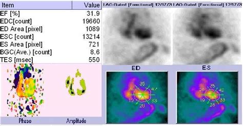 Single Photon Emission Computed Tomography Myocardial Perfusion Imaging