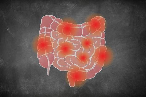 Facts About Crohns Disease