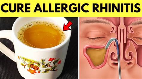 Cure Allergic Rhinitis Permanently And Naturally Using This Home Remedy