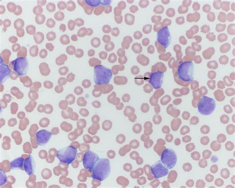 Acute Monoblastic Leukemia Eclinpath