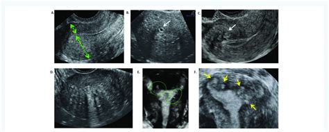 Two Dimensional 2d And Three Dimensional 3d Transvaginal Ultrasound