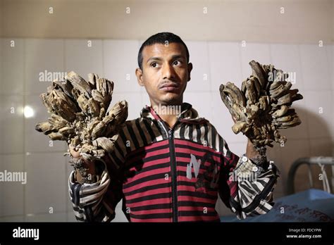 Human Papillomavirus Tree Man