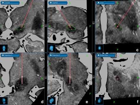 Direct Targeting To The Dorsolateral Border Of The Subthalamic Nucleus