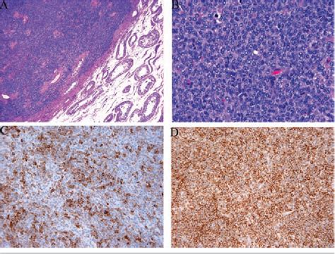 Adult Type Granulosa Cell Tumor Semantic Scholar