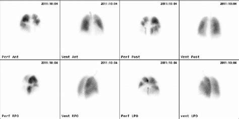 Lung Perfusion Scan In Cteph Showing Homogeneous Ventilation And