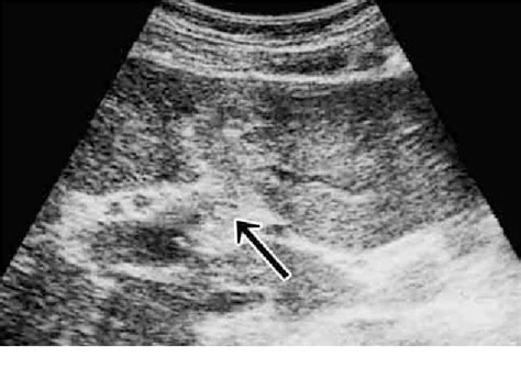 Figure 1 From A Patient With Adult Extrahepatic Portal Obstruction Of
