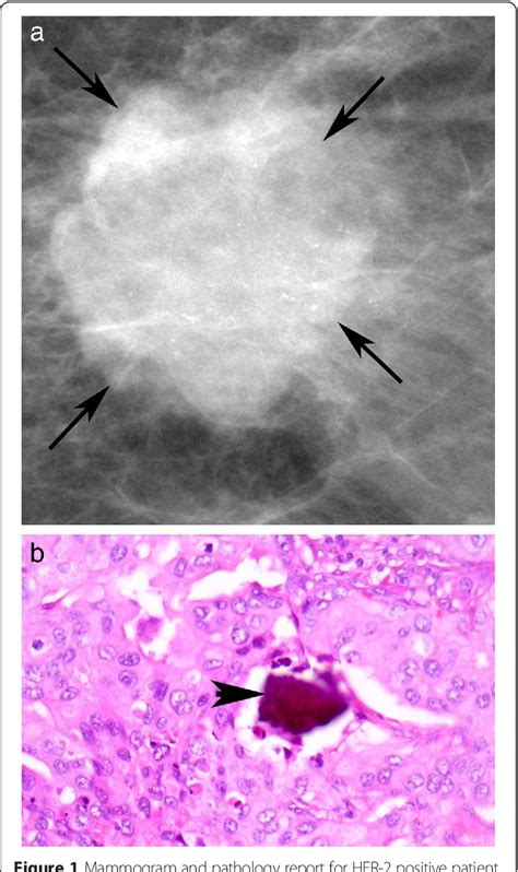Figure 1 From Mammographic Microcalcifications And Breast Cancer