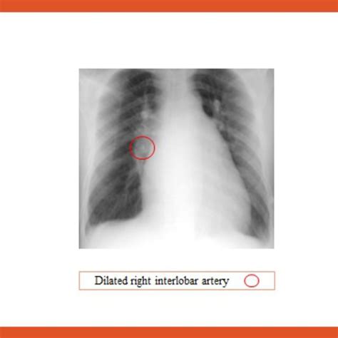 Plain Film Findings Right Interlobar Artery Dilatation Download
