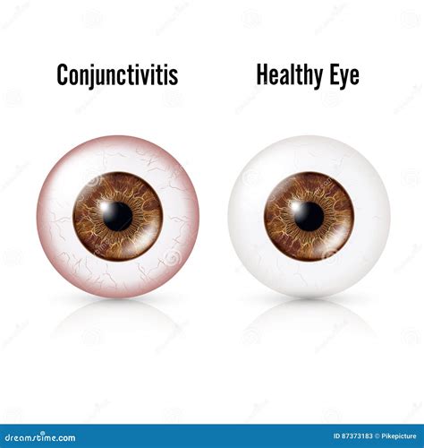 Conjuntivitis Ojo Rojo Ojo Y Globo Del Ojo Sanos Con Conjuntivitis