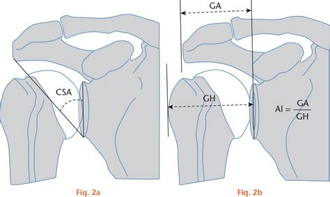 Effect Of Critical Shoulder Angle Glenoid Lateralization And Humeral
